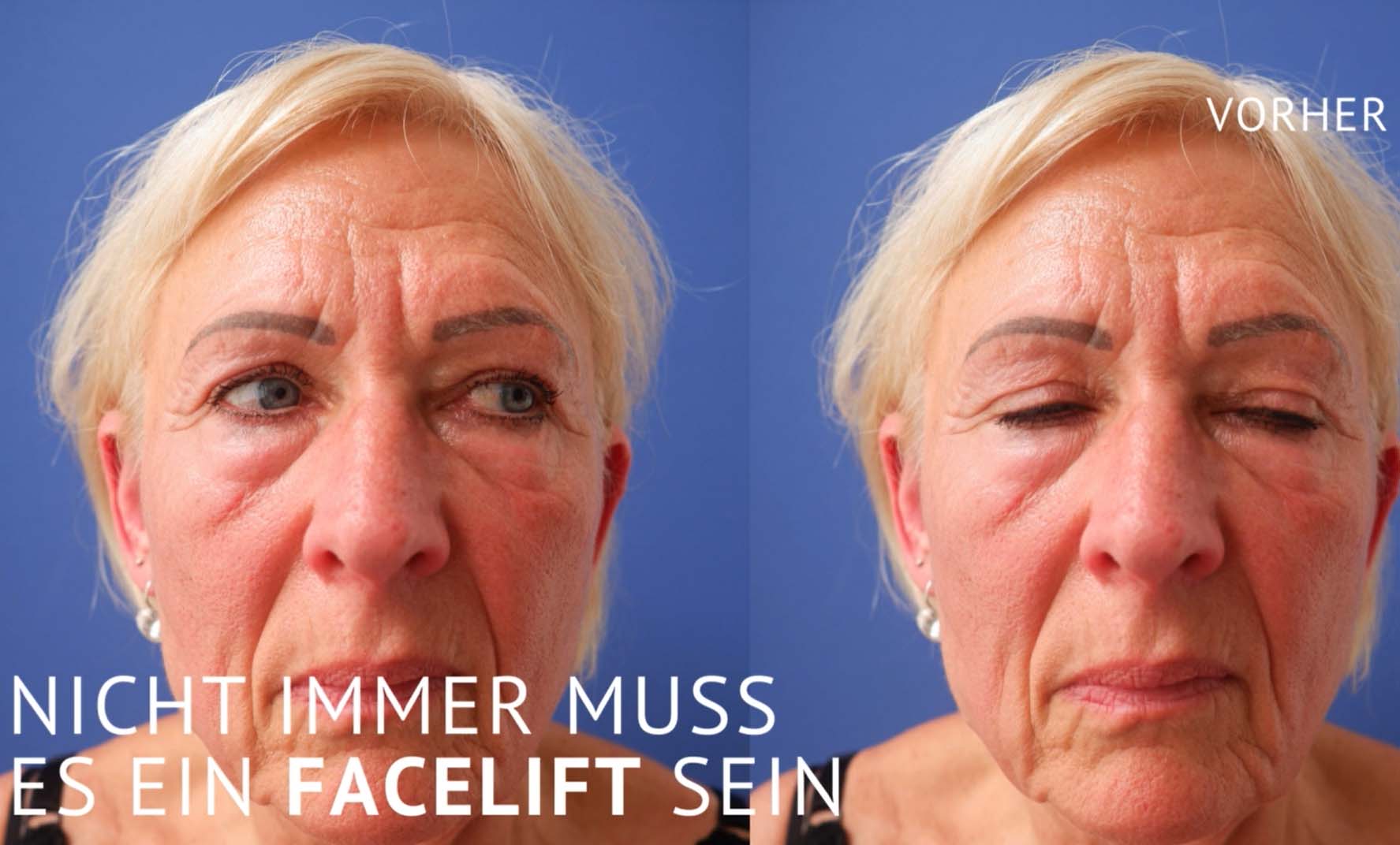 Gesichtsfalten glätten mit Eigenfett | Docure Berlin